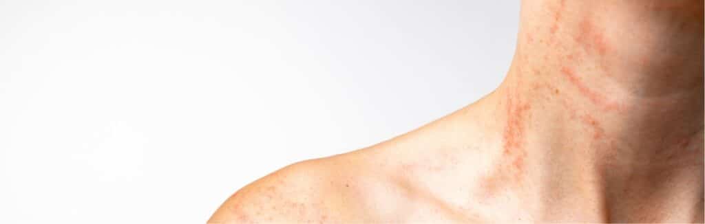 Rashes Jacksonville Beach FL - Skin Eruption Palm Valley FL